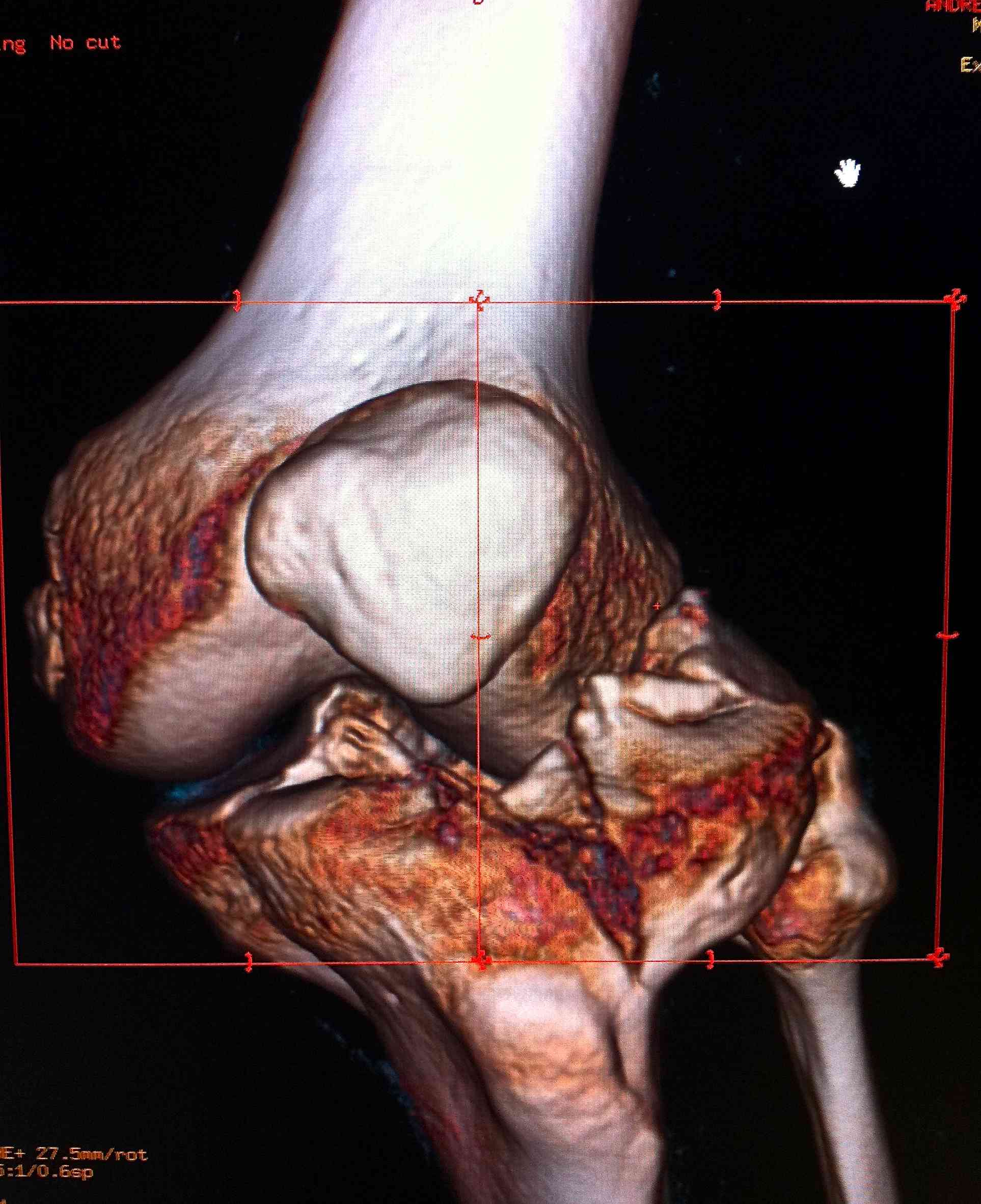 Fratura_de_plato_tibial | Insport